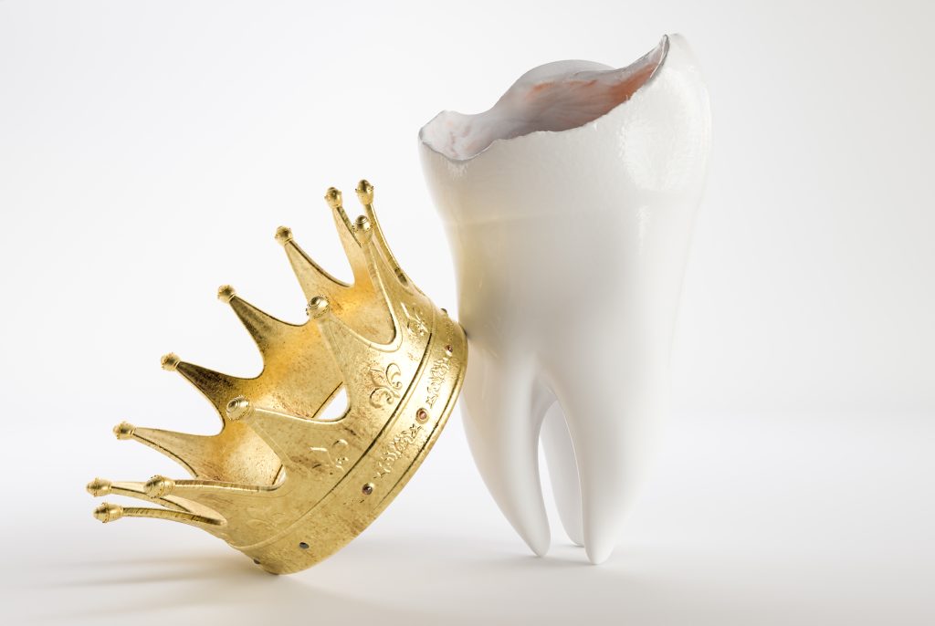 The Royal Treatment, Restorative Solutions- Crowns and Bridges - Ashraf ...